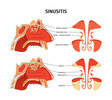 Nose sinusitis anatomy Illustration vector free download